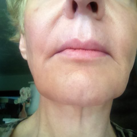 Derminator digital dermaneedling