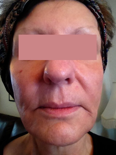 Derminator digital dermaneedling